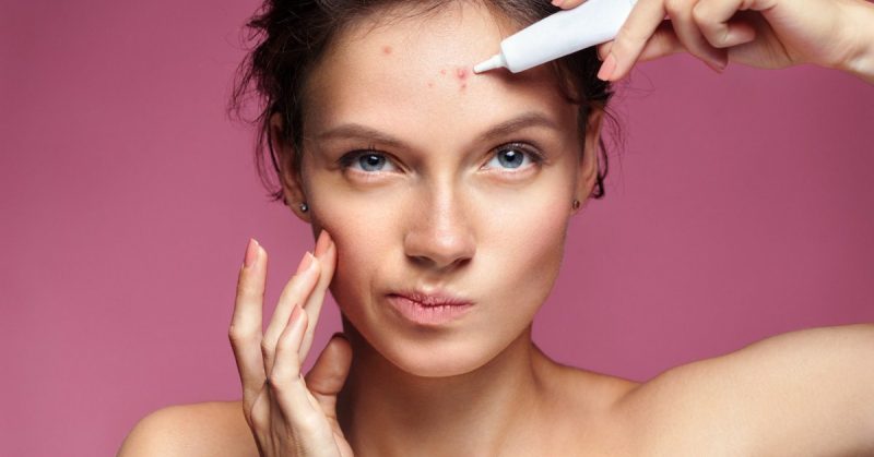 Mapa da Acne: entenda o que significam em cada região do rosto - Quem ...